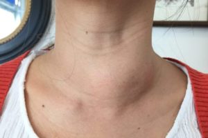 Goiter: Signs and Symptoms and Treatment