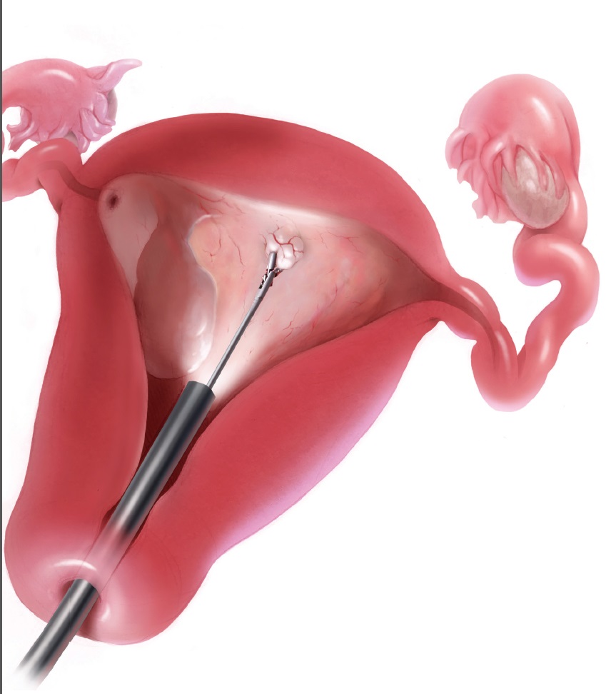 Postmenopausal Bleeding